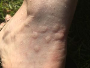 Stung while in river | Ask a Naturalist®